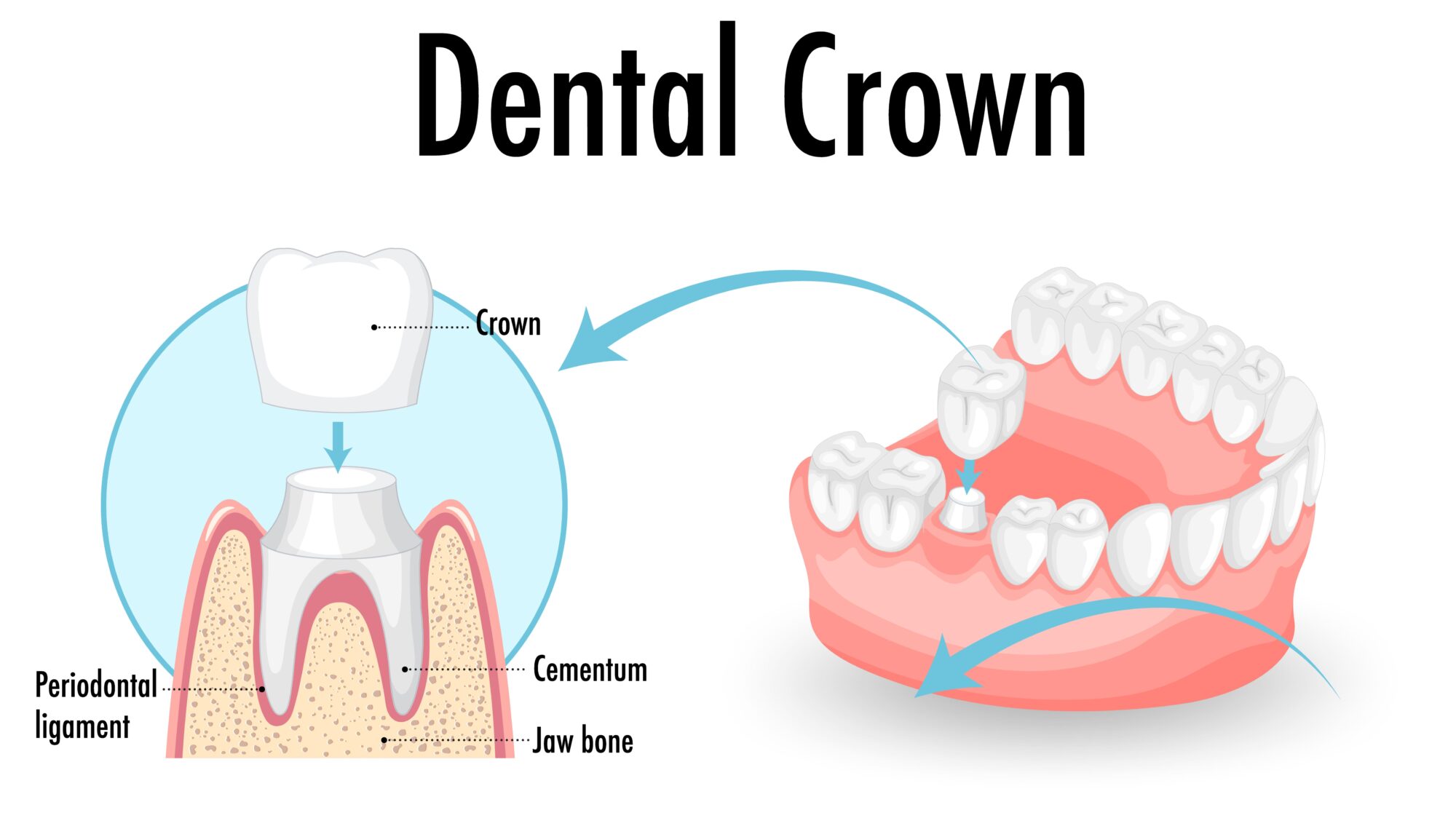 How Dental Crowns Can Save Your Natural Teeth - Sunridge